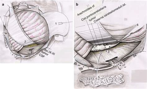 Retrosigmoid Approach To The Posterior And Middle Fossa Neupsy Key