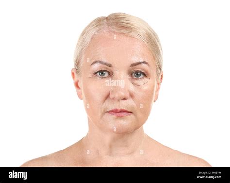 Mature Woman With Marks On Her Face Against White Background Concept Of Plastic Surgery Stock