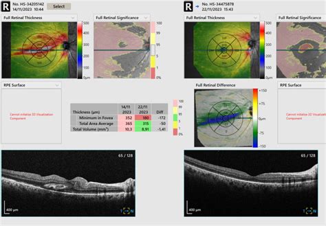 Macular Fold After Retinal Retinal Detachment Surgery This Patient Was Rapidly And Effectively