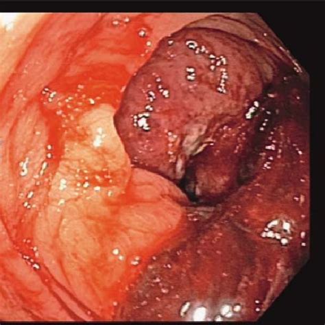 Colonoscopy View Of The Tumor In The Hepatic Flexure Download