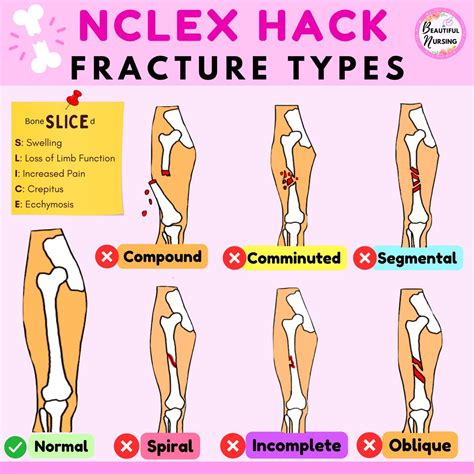 Fracture Types For Nursing Artofit
