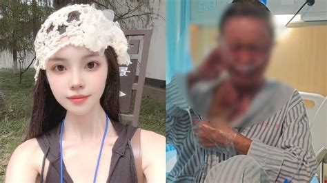 30岁高颜值女子头孢过敏导致毁容：没有头孢过敏史，护士说我很痛是正常的腾讯新闻