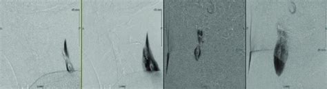 Embosphere Injection Embospheres Mixed With Contrast Are Seen