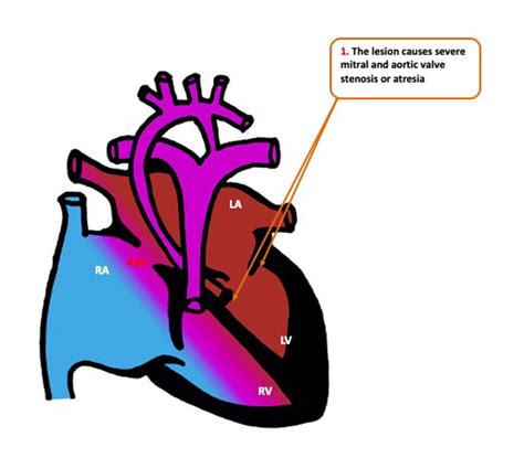 Congenital Aortic Stenosis