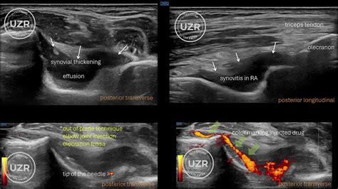 Giorgio Tamborrini On Linkedin Elbow Joint Injection Olecranon Fossa Rheumatoid Arthritis Out