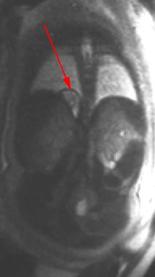 Congenital Lung Disease