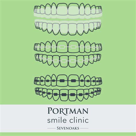 Portman Smile Clinic Sevenoaks 🔎 Curious About The Types Of Braces We