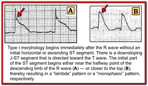 A 35 Year Old Woman With This Post Rosc Ecg What Does Shark Fin