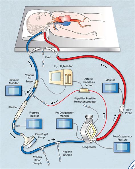 Extracorporeal Membrane Oxygenation For Hemodynamic Support Clinics