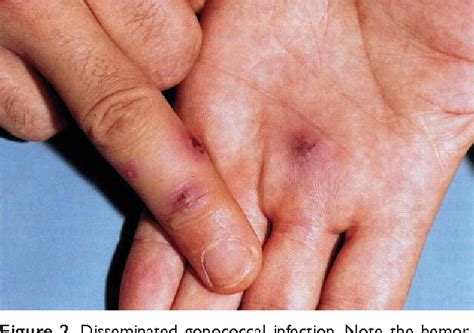 Gonococcal Infection Symptoms