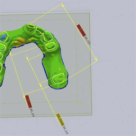Colour Coded Deviation View Of The Superimposition And Digital