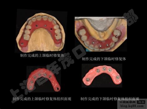 全口无牙颌即刻种植即刻负重 金 辰的博客 KQ88口腔博客