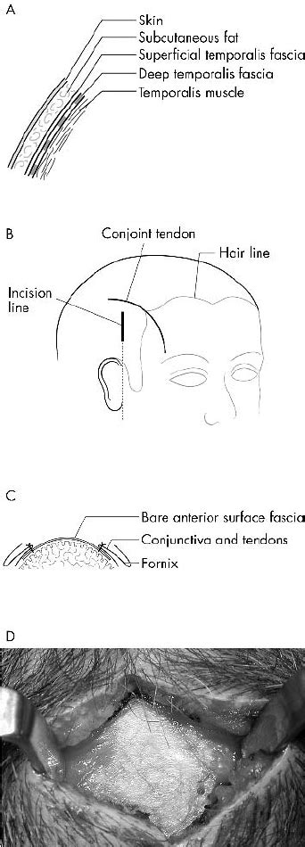 A Diagram Showing Layers Of The Scalp Overlying The Temporalis Download Scientific Diagram