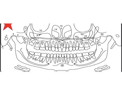 Landmarks Of Maxilla Surrounding Structures Quiz