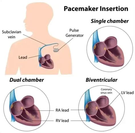Permanent Pacemaker Ppm In Singapore Harley Street