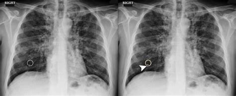 Pcp Chest X Ray