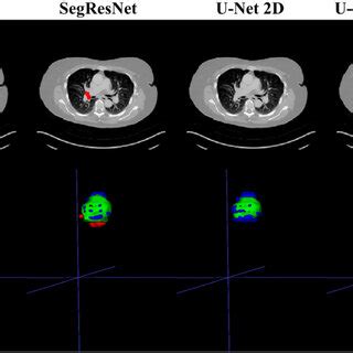 Comparison Of Different Method Segmentation Results With Large Tumors