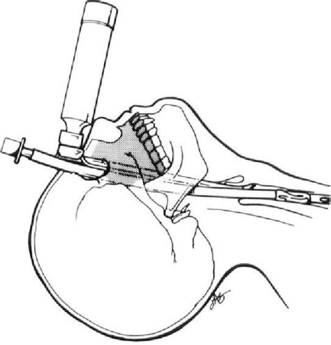 Transorbital Endotracheal Intubation This Ingenious Method Was Used To