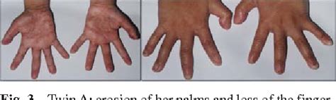 Figure 3 From Ankyloblepharon Ectodermal Defects Cleft Lip Palate Aec Syndrome In Monozygotic