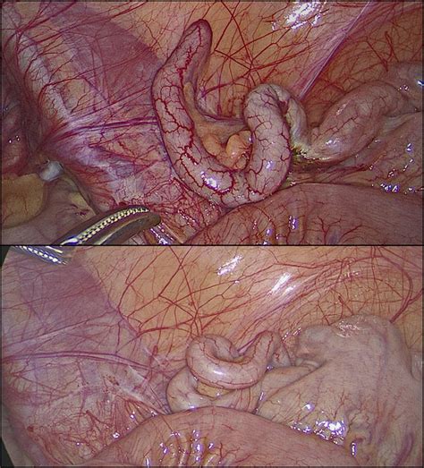 Macroscopically Normal‐looking Appendix Discovered During Diagnostic