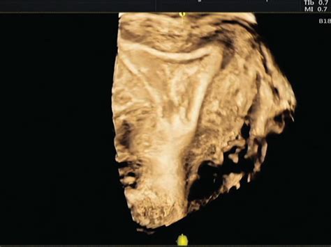 Female 32 Years Old A Endometrial Polyp Seen On Vaginal Ultrasound Download Scientific