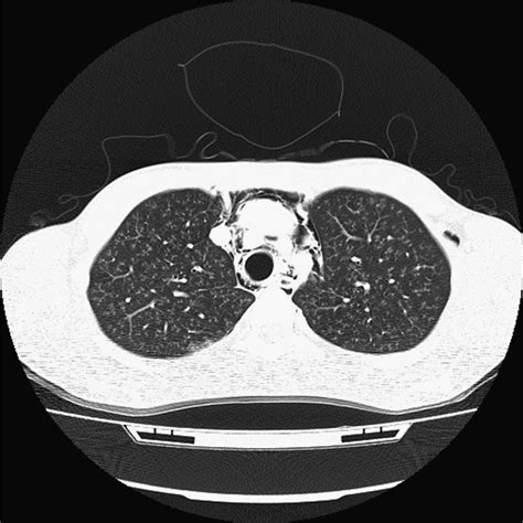 Tree In Bud Attributable To Organising Pneumonia Thorax