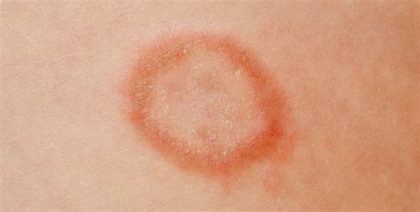 Tiña Dermatofitosis Qué Es Síntomas Y Tratamiento