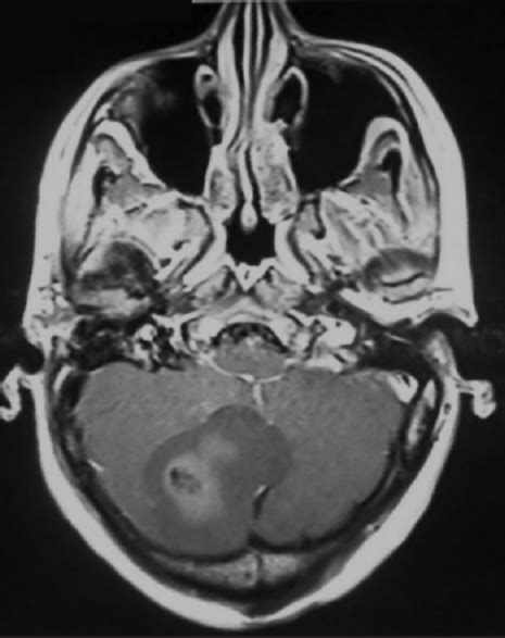 Atypical Imaging Features Of Posterior Fossas Dermoid Cyst Case