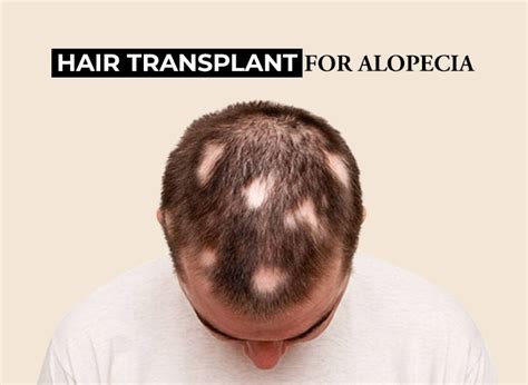 Why Hair Transplant Is A Better Treatment Option For Alopeciaskin Lattice