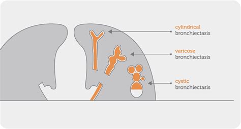 Bw Types Of Bronchiectasis Bronchiectasis