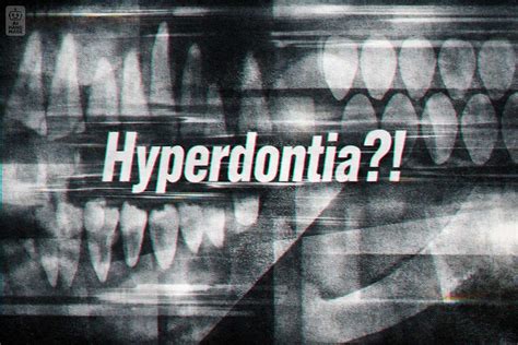 🧪 Hyperdontia If You Have Extra Teeth 📖 By Why R We Jan 2026