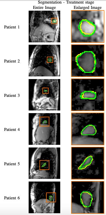 real time lung tumor tracking using a cuda enabled nonrigid