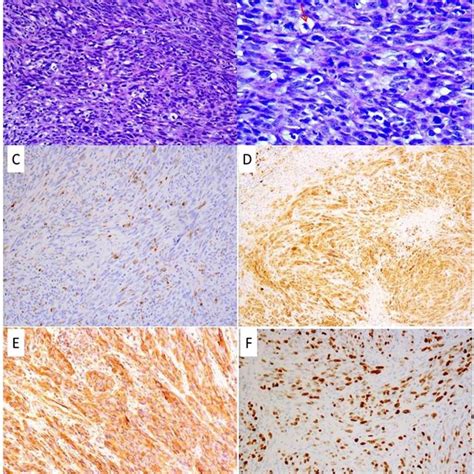 Histologic Sections Of Case 2 Displayed The Sheets Of Atypia Of