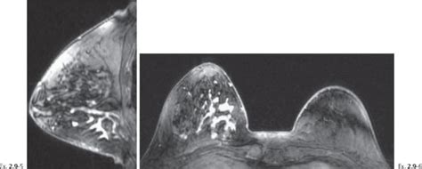 The Evolution Of Casting Type Calcifications Oncohema Key