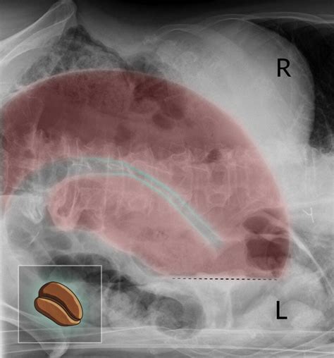 Cecal Volvulus Vs Sigmoid Volvulus