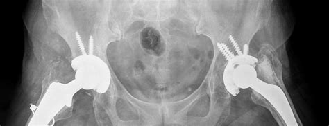Hip Replacement Surgery Johns Hopkins Medicine