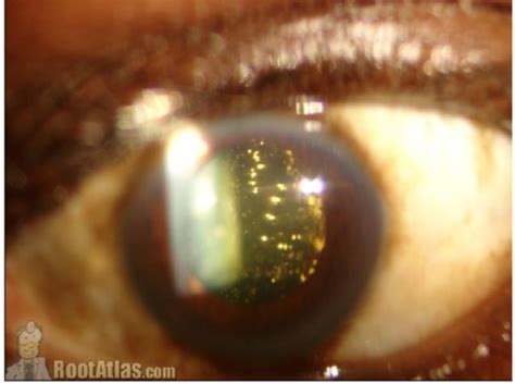 Lecture 1 Infectious Retinal Disorders Flashcards Quizlet