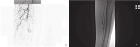 ­angiographic View Of Peroneal Artery Pseudoaneurysm Download Scientific Diagram