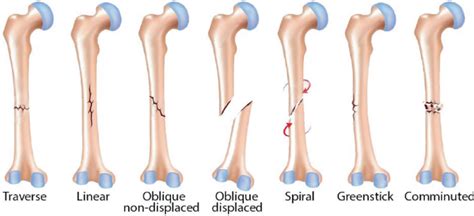 Revolutionizing Bone Fracture Diagnosis Through Deep Learning