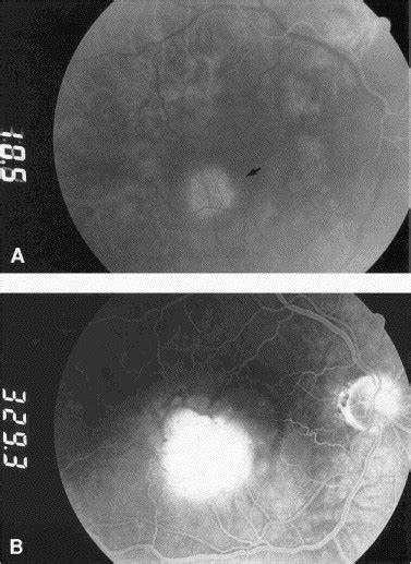 Choroidal Tubercles