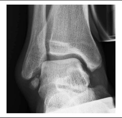 Figure 1 From The Effect Of Ossicle Resection In The Lateral Ligament Repair For Treatment Of