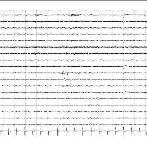 Eeg During The Myoclonic Status Epilepticus Before The Administration