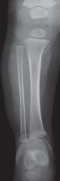 Female Tibia And Fibula Radiology Key