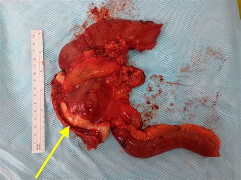Real Appendix The Appendix Retrocecal Arterial Supply
