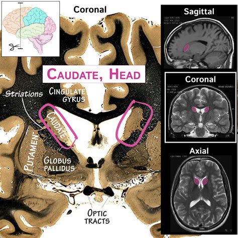 Neuroanatomy Glossary Caudate Nucleus Head Ditki Medical