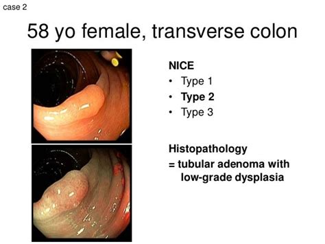 Portfolio Of Colonic Polyps