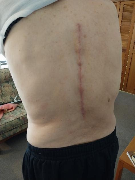 Lumbar Discectomy Surgery Scar