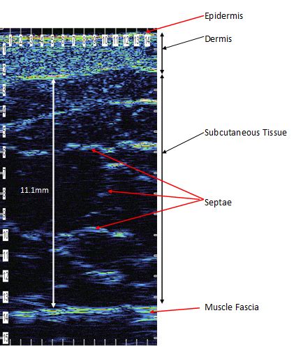 Skin Structure Of Skin Epidermis Dermis Hypodermis