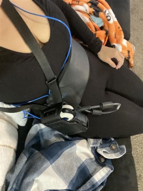 Gi Bleeding Rcrohnsdisease