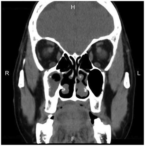 Ostium Maxillary Sinus